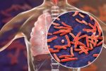 WHO demands urgent funding for tuberculosis in Nigeria
